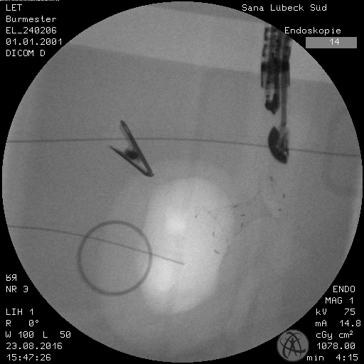 Metallstent in Pseudozyste | metal stent within pseudocyst